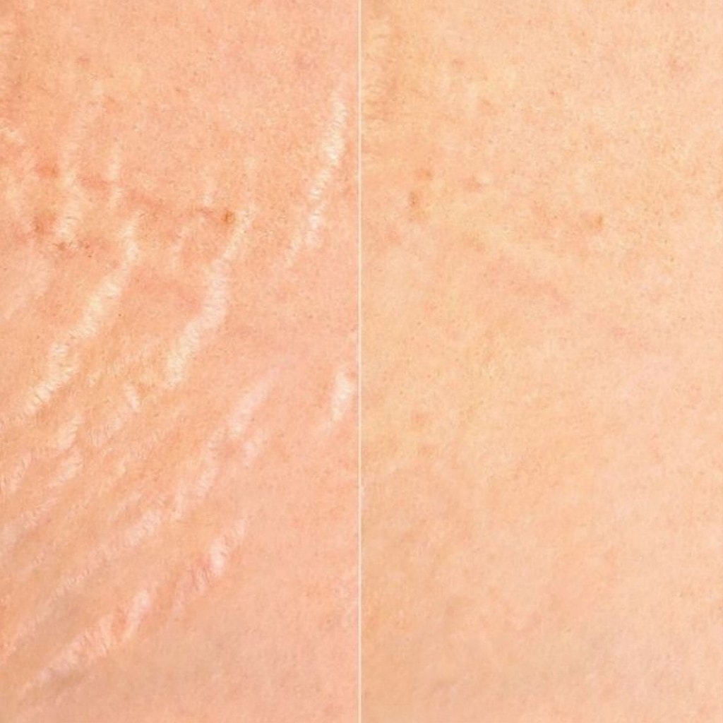 Scar And Stretch Marks Camouflage Omaha Valeriya Life Medical Spa